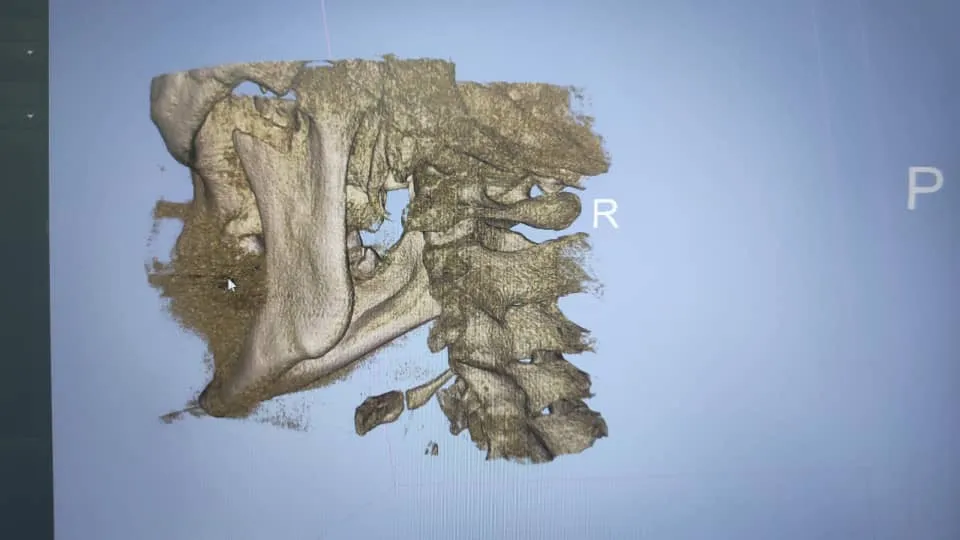 Cervical Spine Column by AndresG - MakerWorld