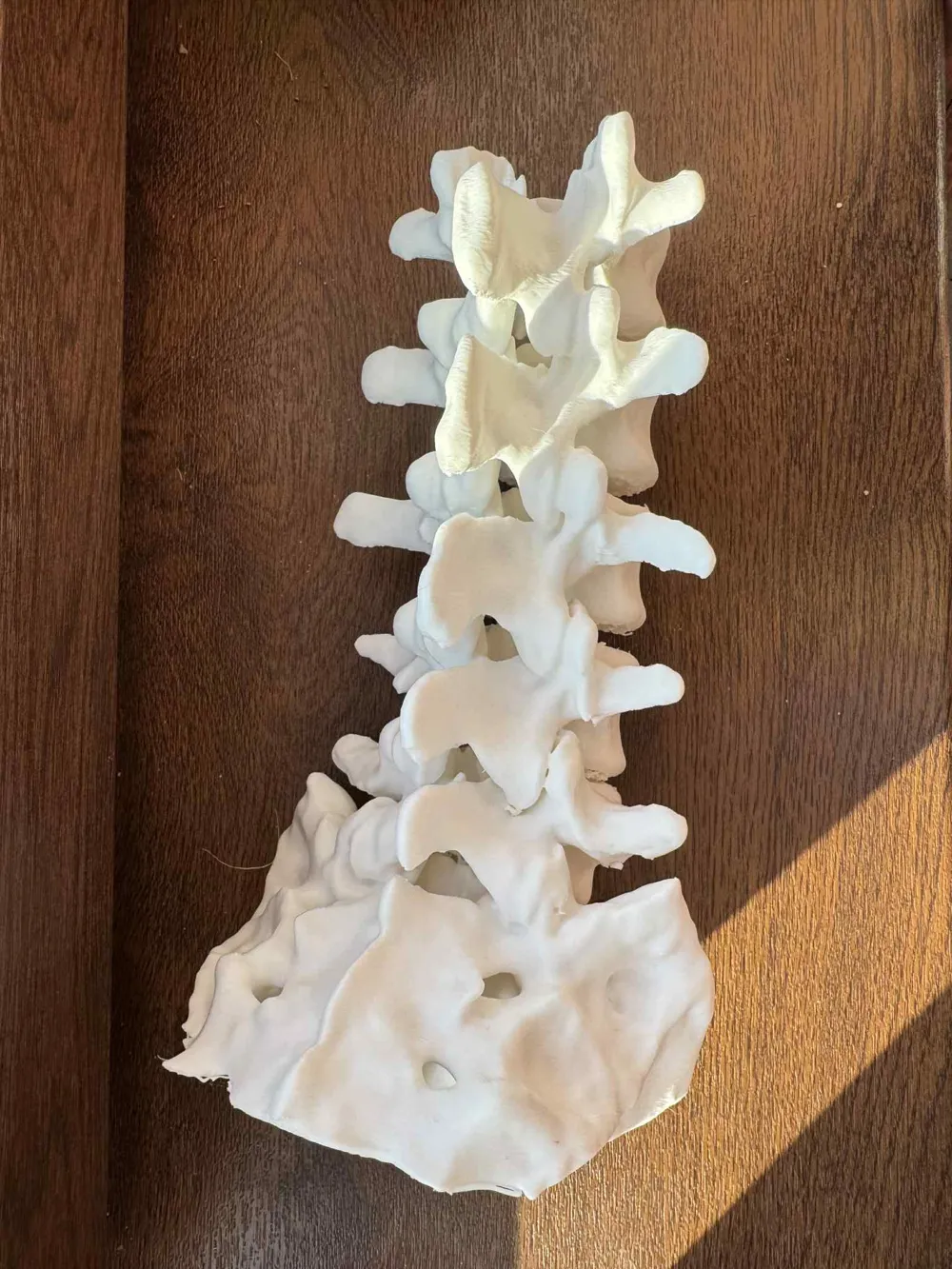 Lumbar Spine - Real Patient 3D Model by Arthrex MakerWorld: Download ...