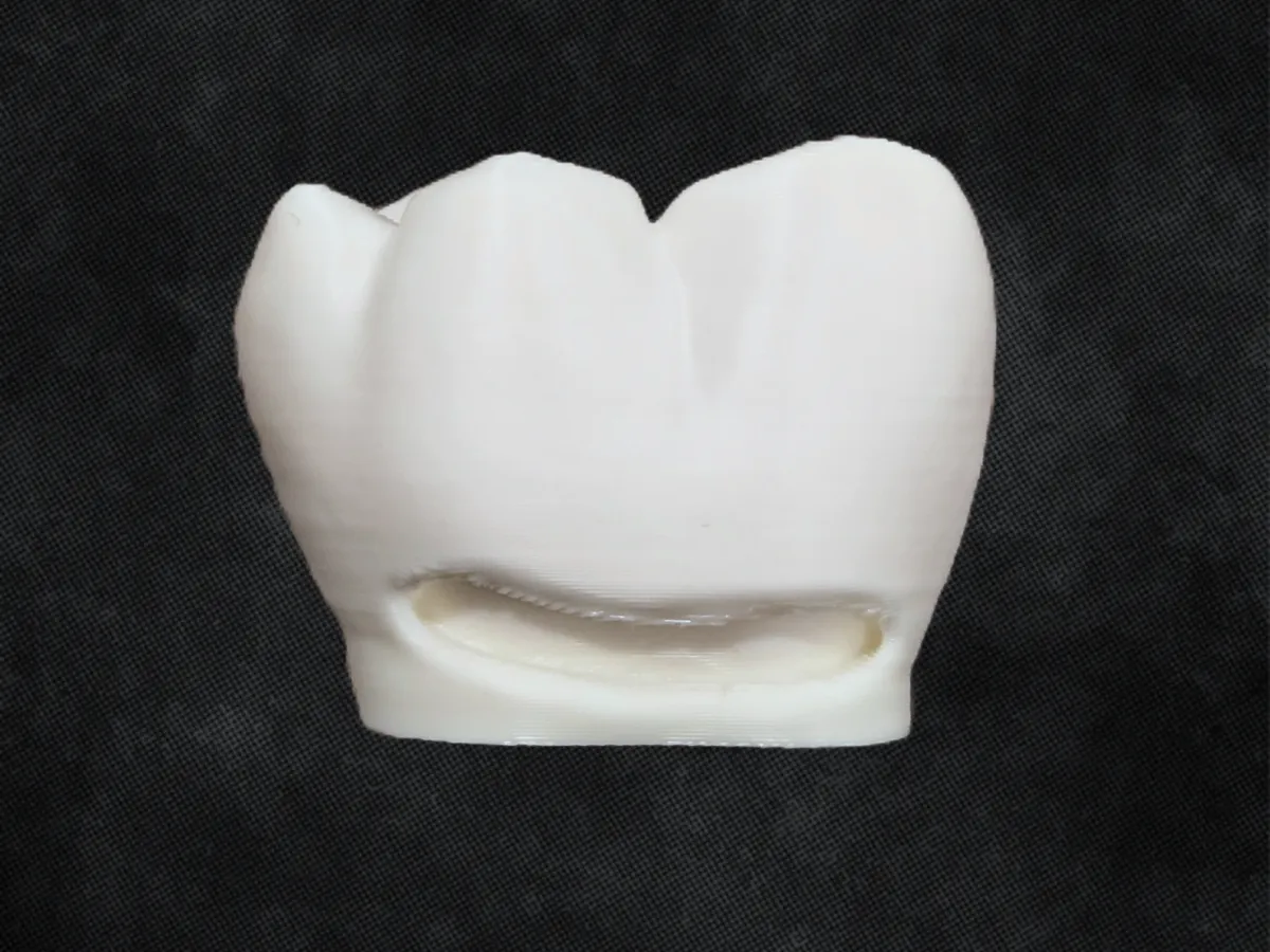 Tooth Preparation Model - Class 5 Filling LR - Free 3D Print Model ...