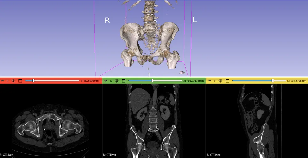 Real Human Hip (From CT scan) by Big Simi MakerWorld: Download Free 3D ...