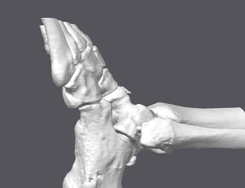 ANKLE TALUS FRACTURE by GM_ENDURANCE_3D MakerWorld: Download Free 3D Models