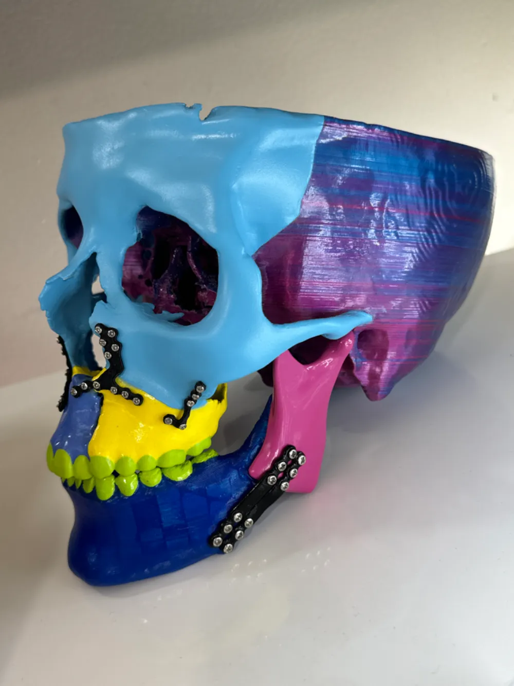 Orthognathic Surgery Anatomical Skull Model by Connor - MakerWorld
