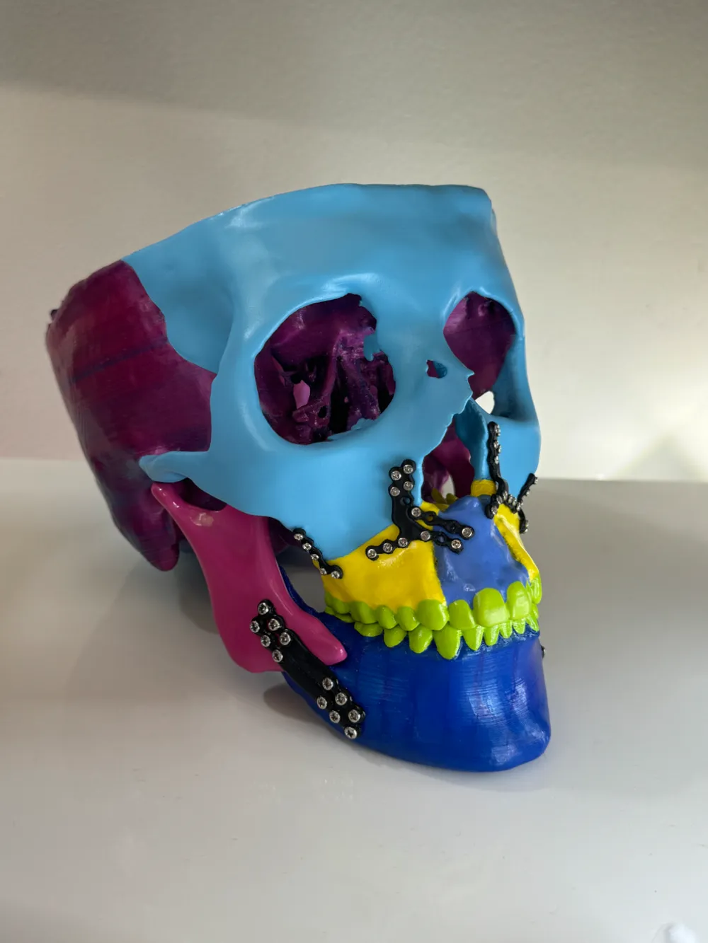 Orthognathic Surgery Anatomical Skull Model - Free 3D Print Model ...
