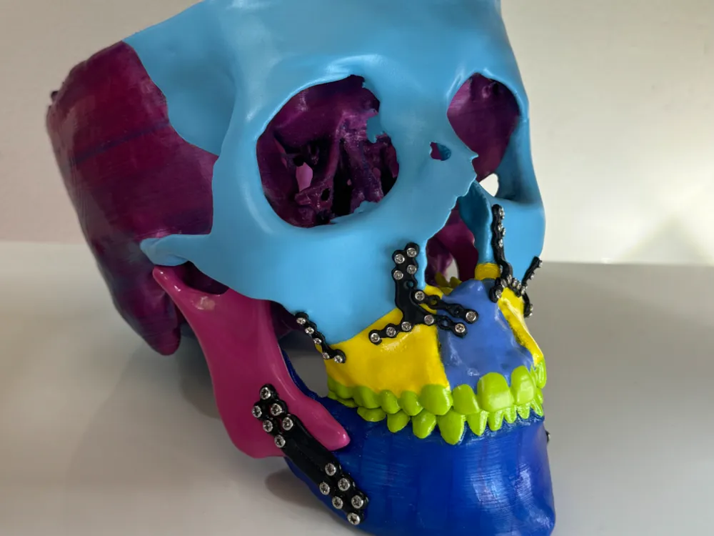 Orthognathic Surgery Anatomical Skull Model - Free 3D Print Model ...